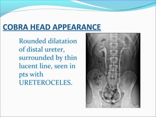 Ureterocele Cobra Head Sign