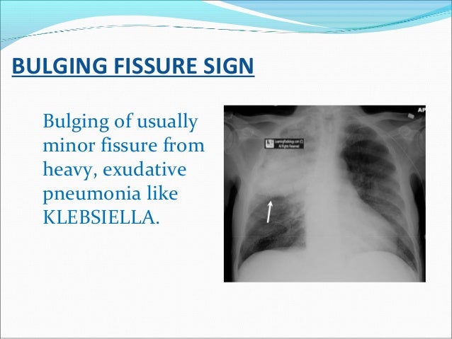 Bulging Fissure Sign The Radiology Assistant : Chest X Ray Lung