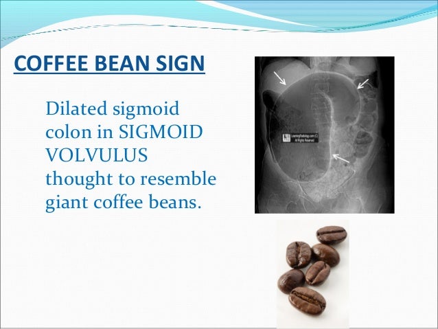 Cecal Volvulus Coffee Bean Sign