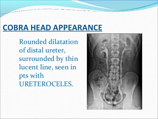 Ureterocele Cobra Head Sign