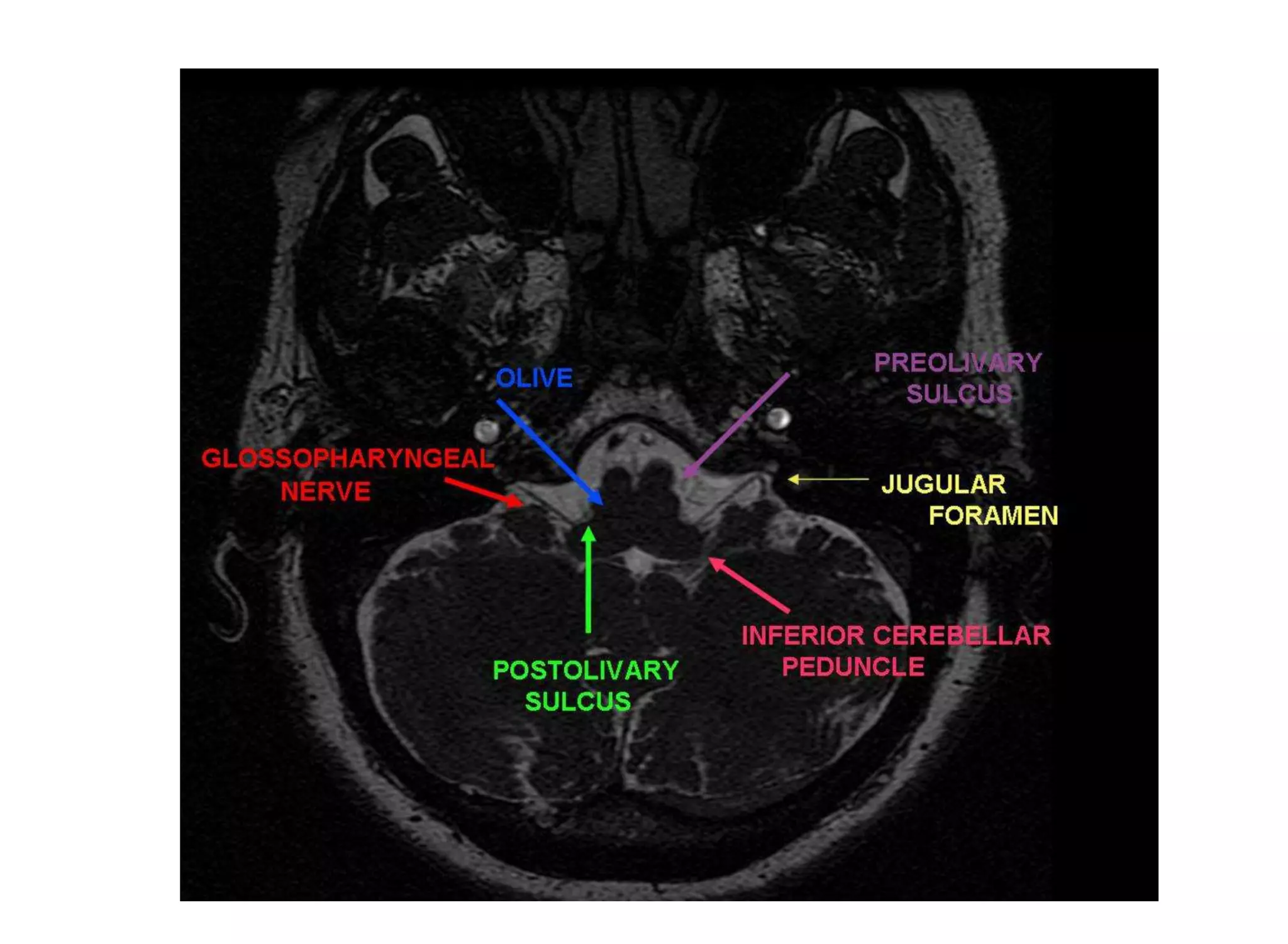 Radiologic anatomy of the cranial nerves | PPTX