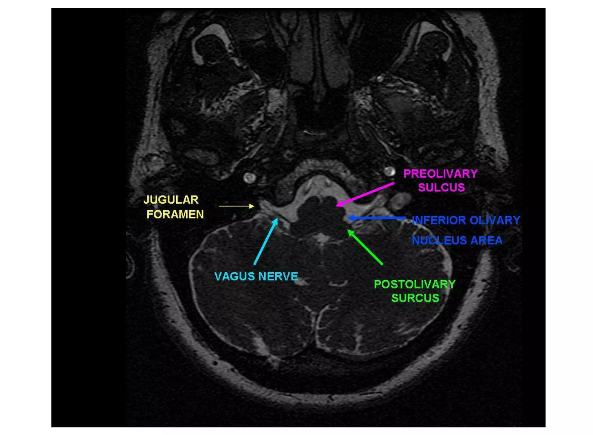 Radiologic anatomy of the cranial nerves | PPTX