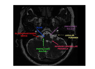 Vestibular Nerve Mri
