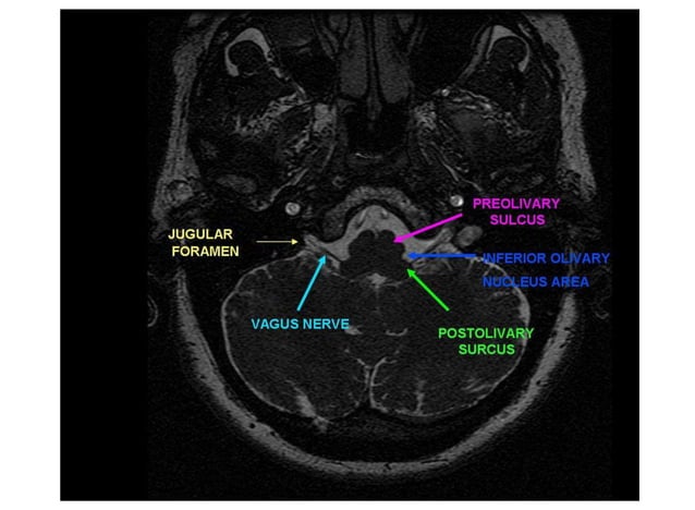 Radiologic anatomy of the cranial nerves | PPT
