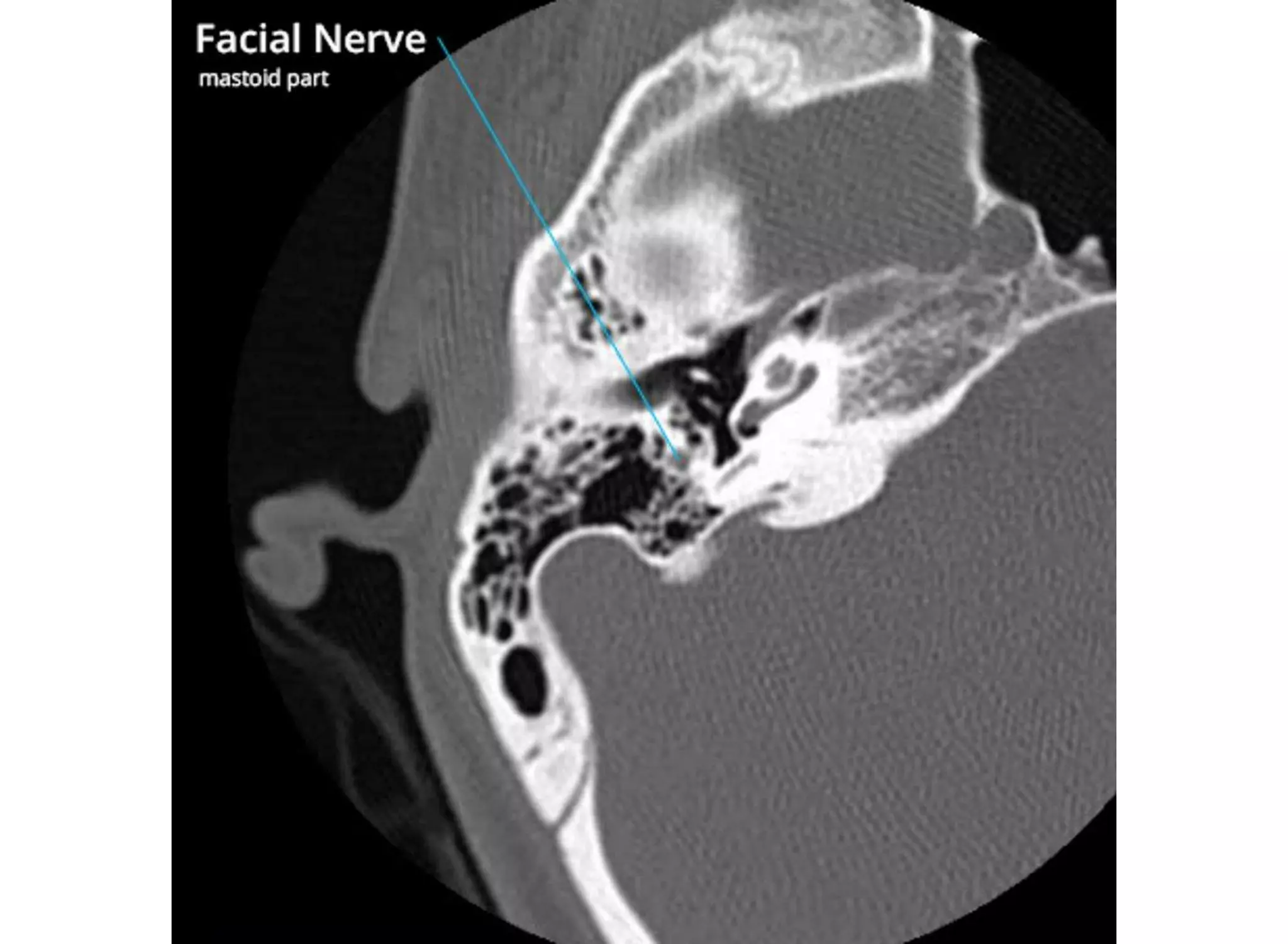 Radiologic anatomy of the cranial nerves | PPTX