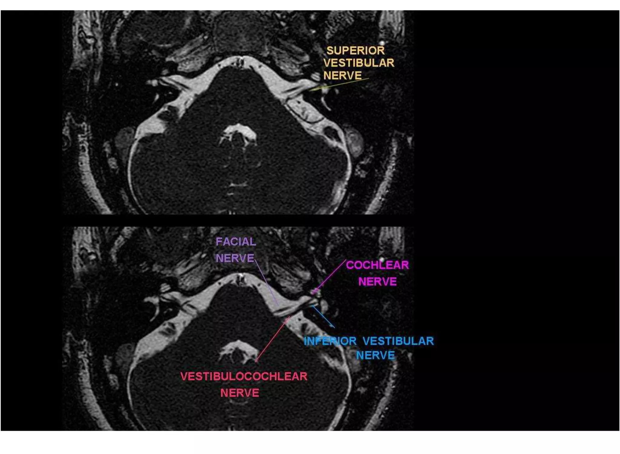 Radiologic anatomy of the cranial nerves | PPTX