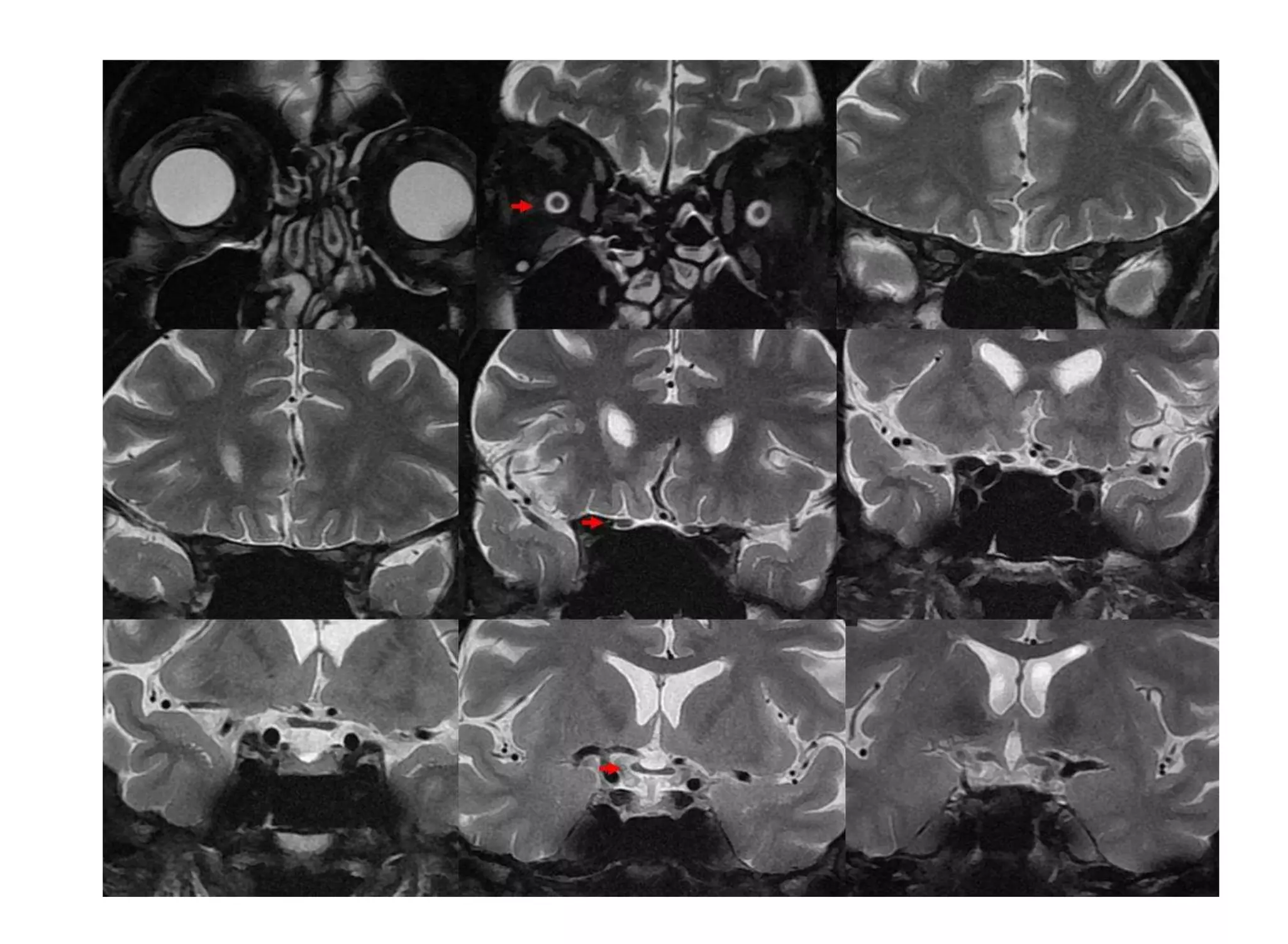 Radiologic anatomy of the cranial nerves | PPTX