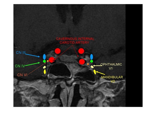 Radiologic anatomy of the cranial nerves | PPTX