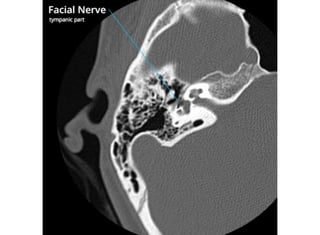 Radiologic anatomy of the cranial nerves | PPTX