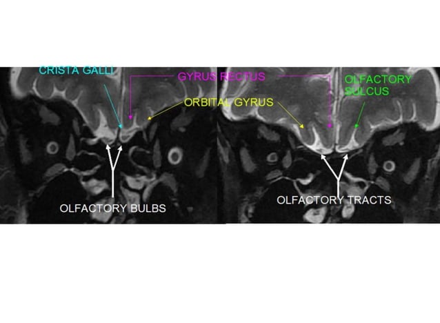 Radiologic anatomy of the cranial nerves | PPT