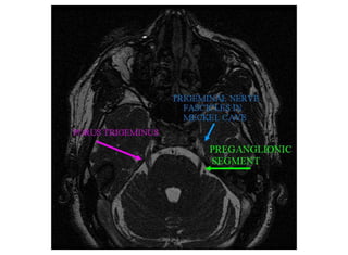 Trochlear Nerve Mri