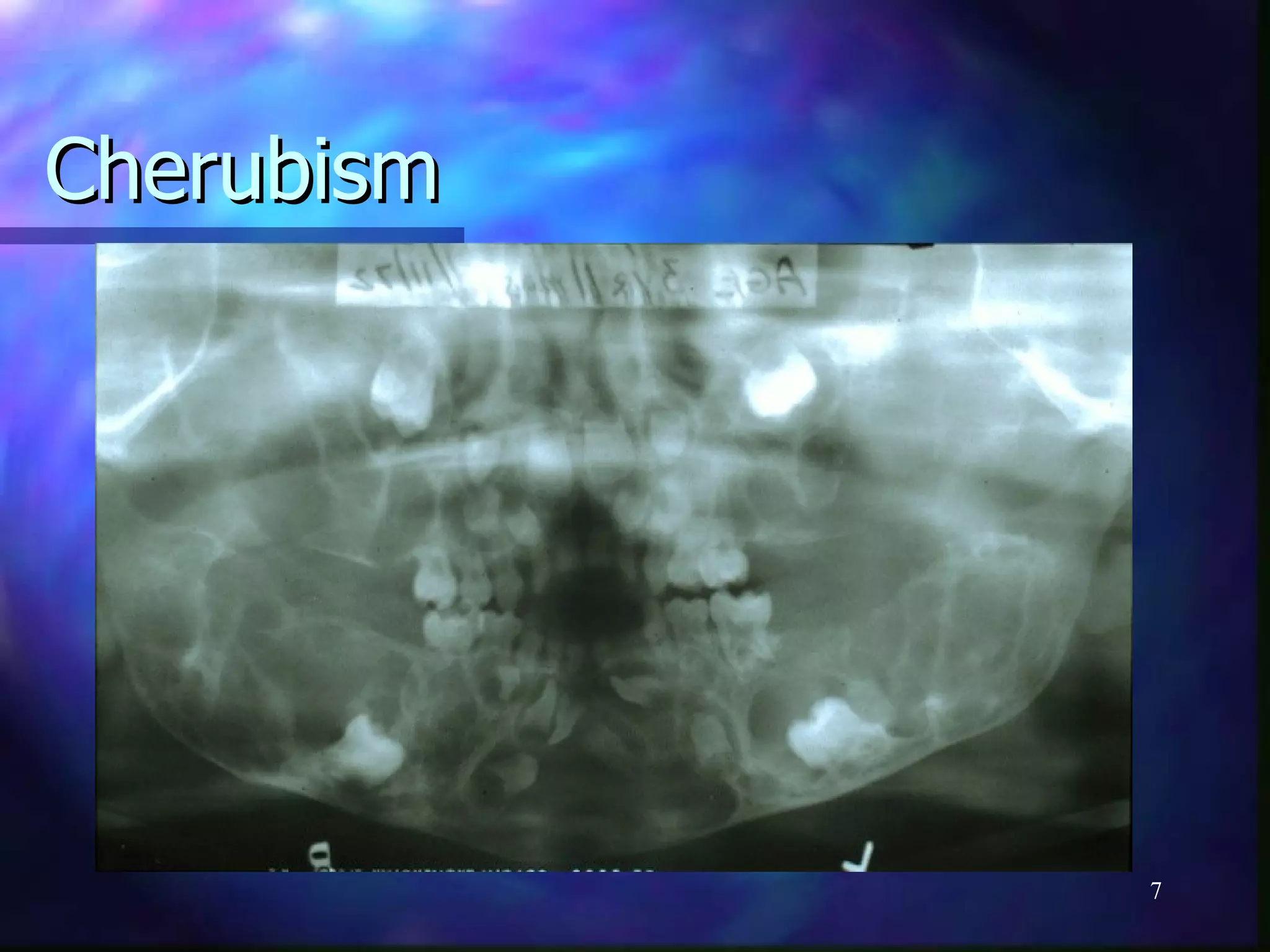 Radiologic features of cherubism | PPT