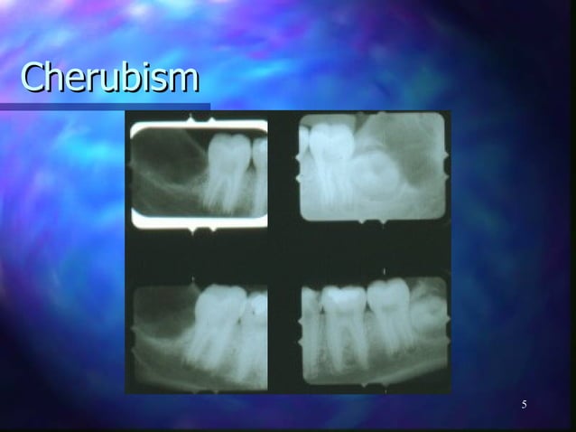Radiologic features of cherubism | PPT | Dental Health | Diseases and ...