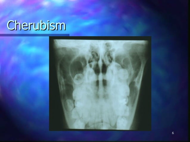 Radiologic features of cherubism | PPT | Dental Health | Diseases and ...