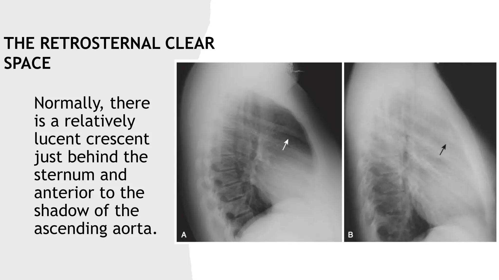 RADIOLOGIC PULMONARY ANATOMY STUDIES.PPT