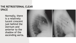 RADIOLOGIC PULMONARY ANATOMY STUDIES.PPT