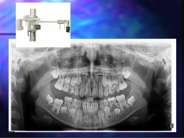 Radiograpy in pediatric dental patient