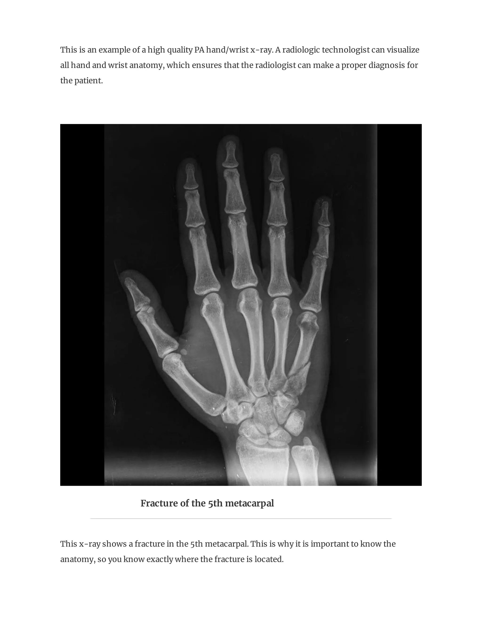 Radiology Anatomy of the Hand and Wrist | PDF | Death, Injury, or ...