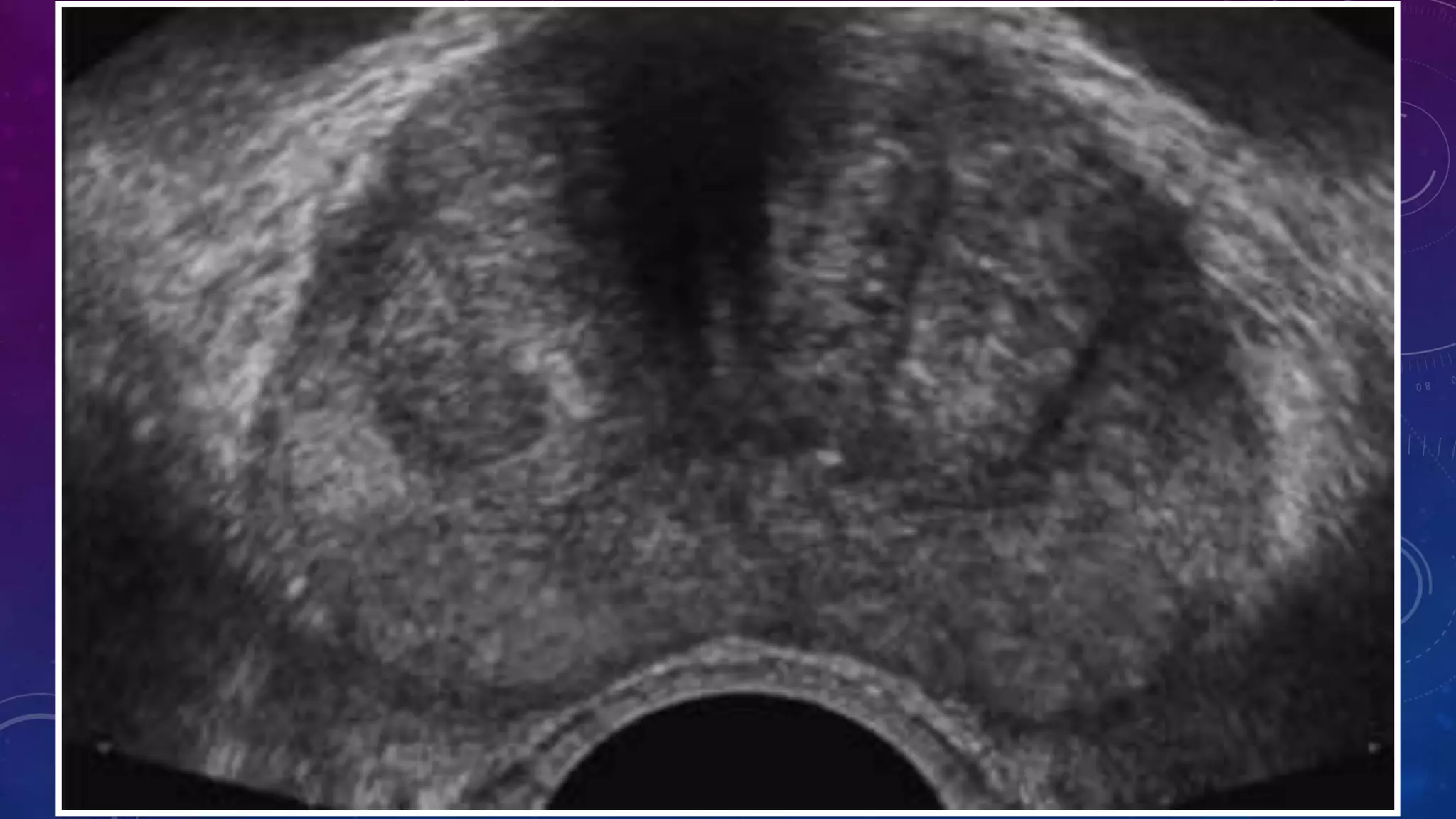 Radiology of reproductive system and breast | PPT