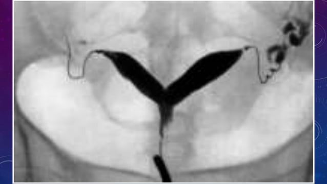 Radiology of reproductive system and breast | PPT