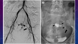 Radiology of reproductive system and breast | PPT