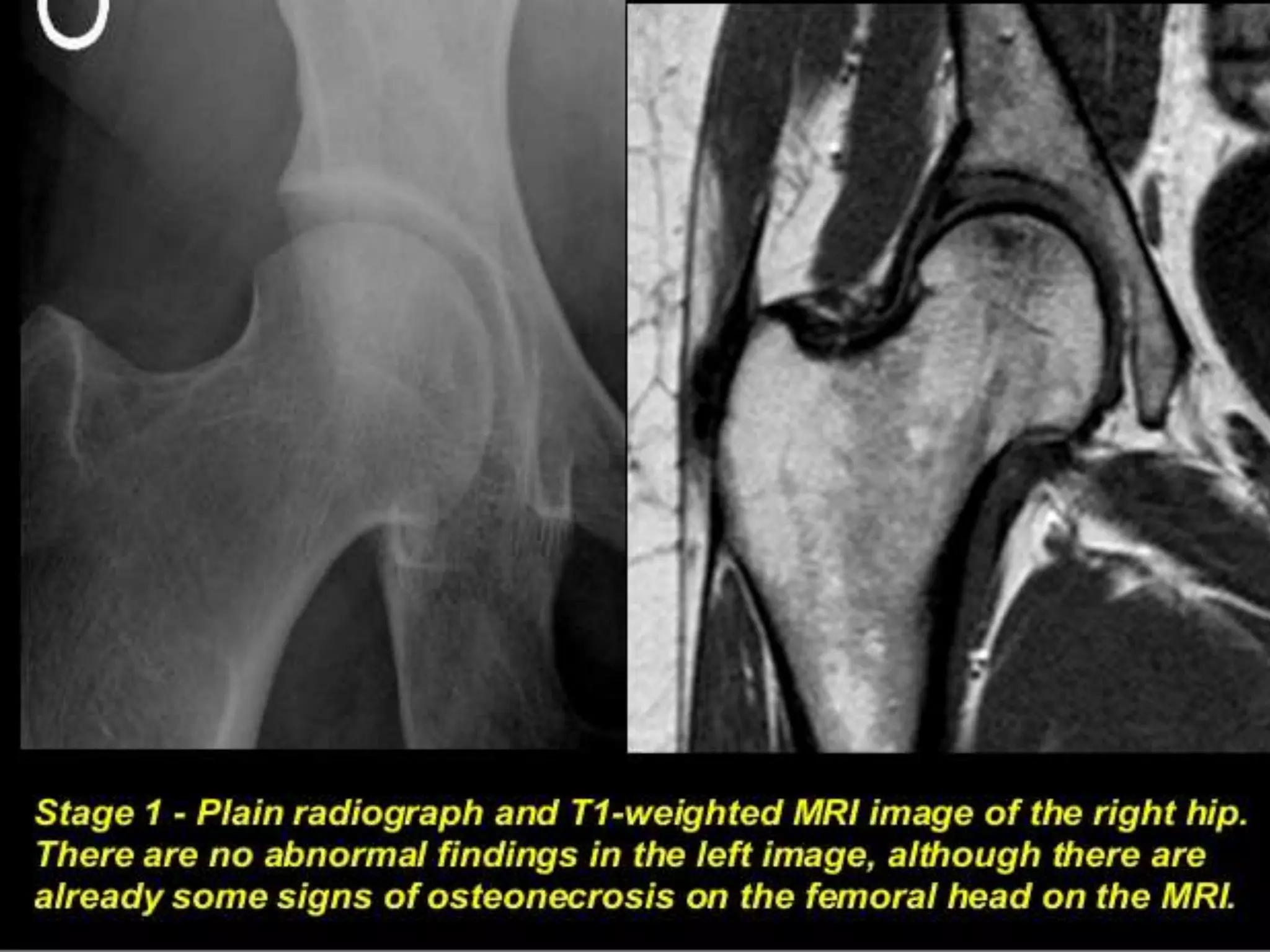 AVN OF HIP JOINT | PPT