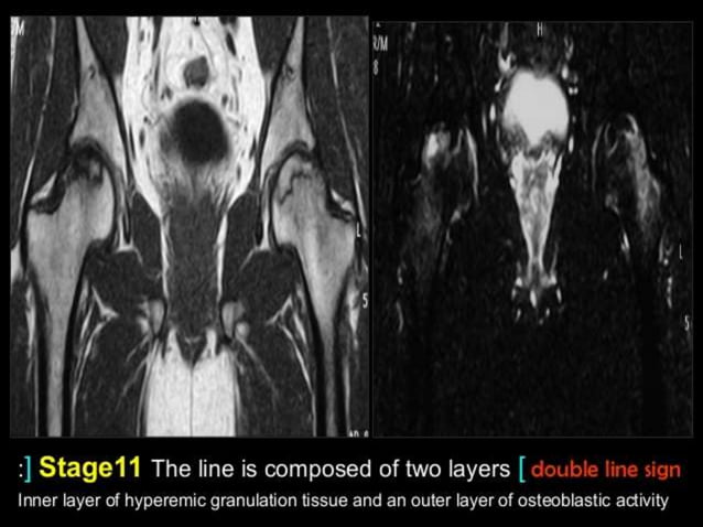 AVN OF HIP JOINT | PPT