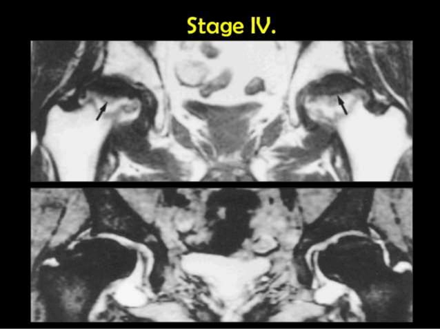 AVN OF HIP JOINT | PPT