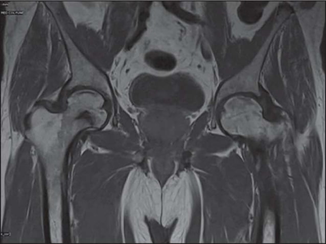 AVN OF HIP JOINT | PPT