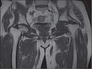 AVN OF HIP JOINT | PPT