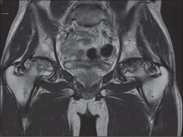 AVN OF HIP JOINT | PPT