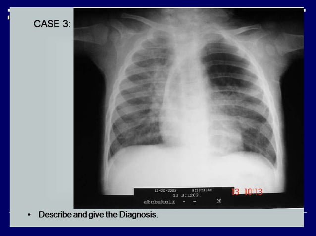 Radiology chest assessment | PPTX | Lung and Respiratory Health ...