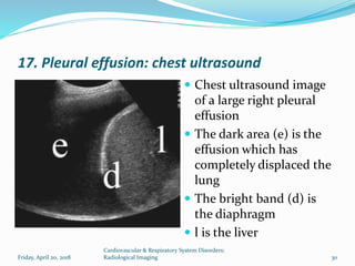 Radiology chs 3101 cardiovascular and respiratory system disorders | PPTX