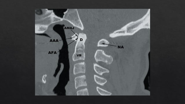Radiology CV junction anomaly AK TMC.pptx