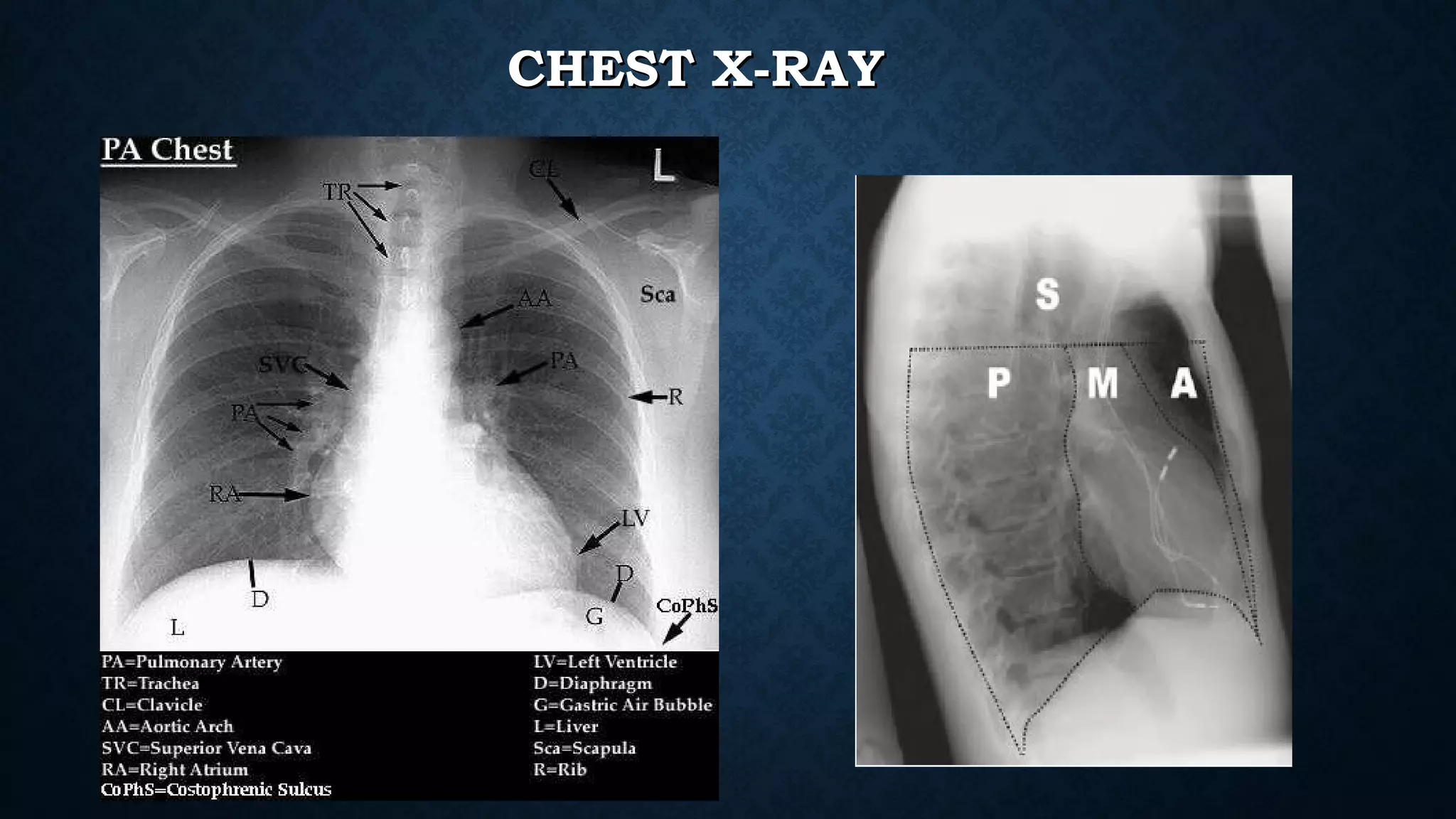 Radiology day 3 mediastinal anatomy | PPT