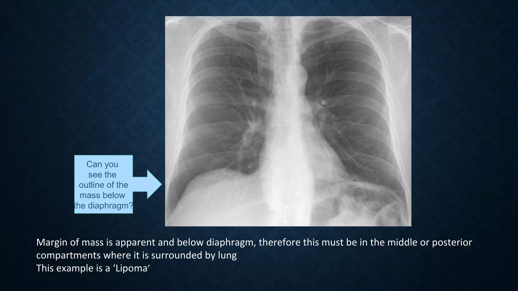 Radiology day 3 mediastinal anatomy | PPT