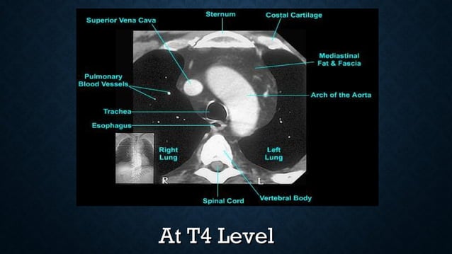 Radiology day 3 mediastinal anatomy | PPT