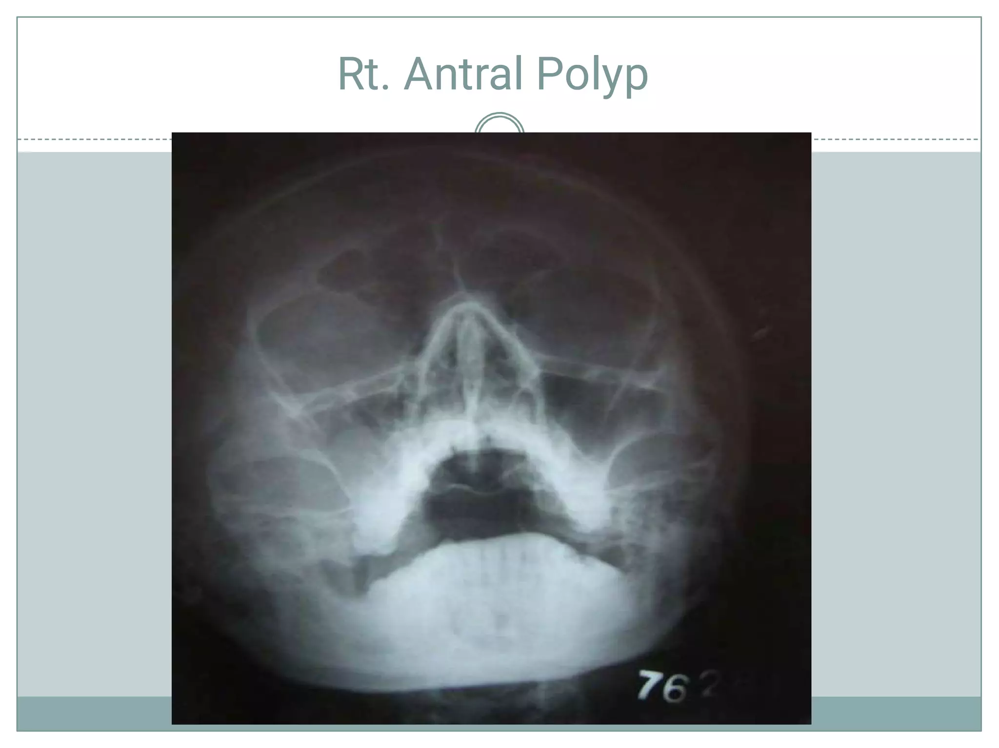 Radiology ENT.pdf | Ear, Nose and Throat Conditions | Diseases and ...