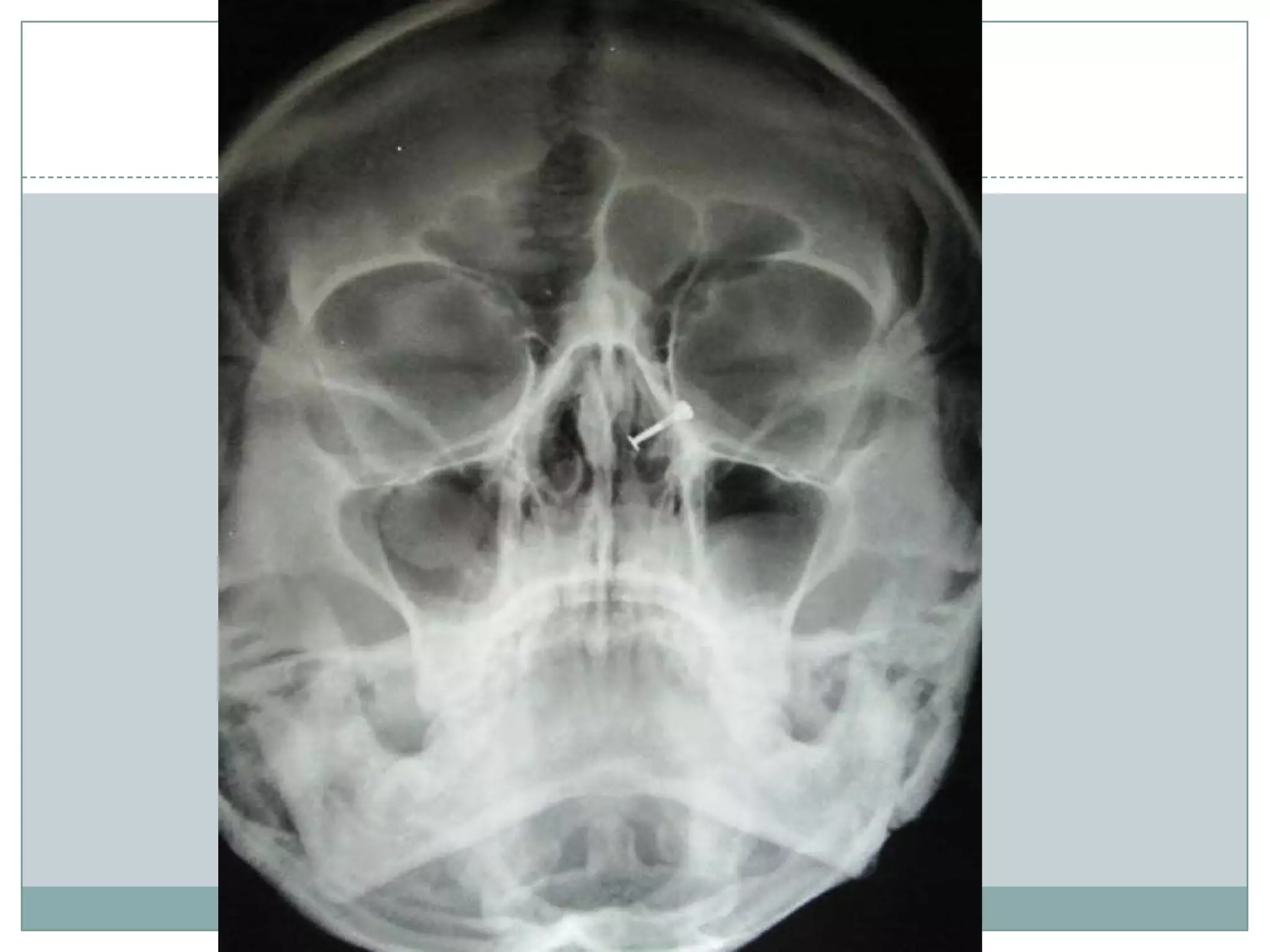 Radiology ENT.pdf | Ear, Nose and Throat Conditions | Diseases and ...