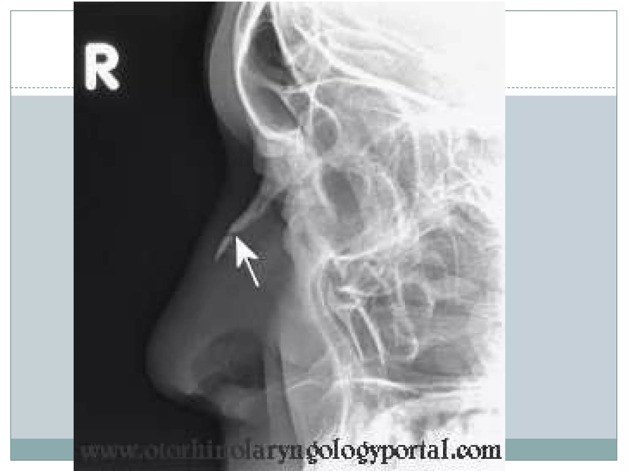 Radiology ENT.pdf | Ear, Nose and Throat Conditions | Diseases and ...