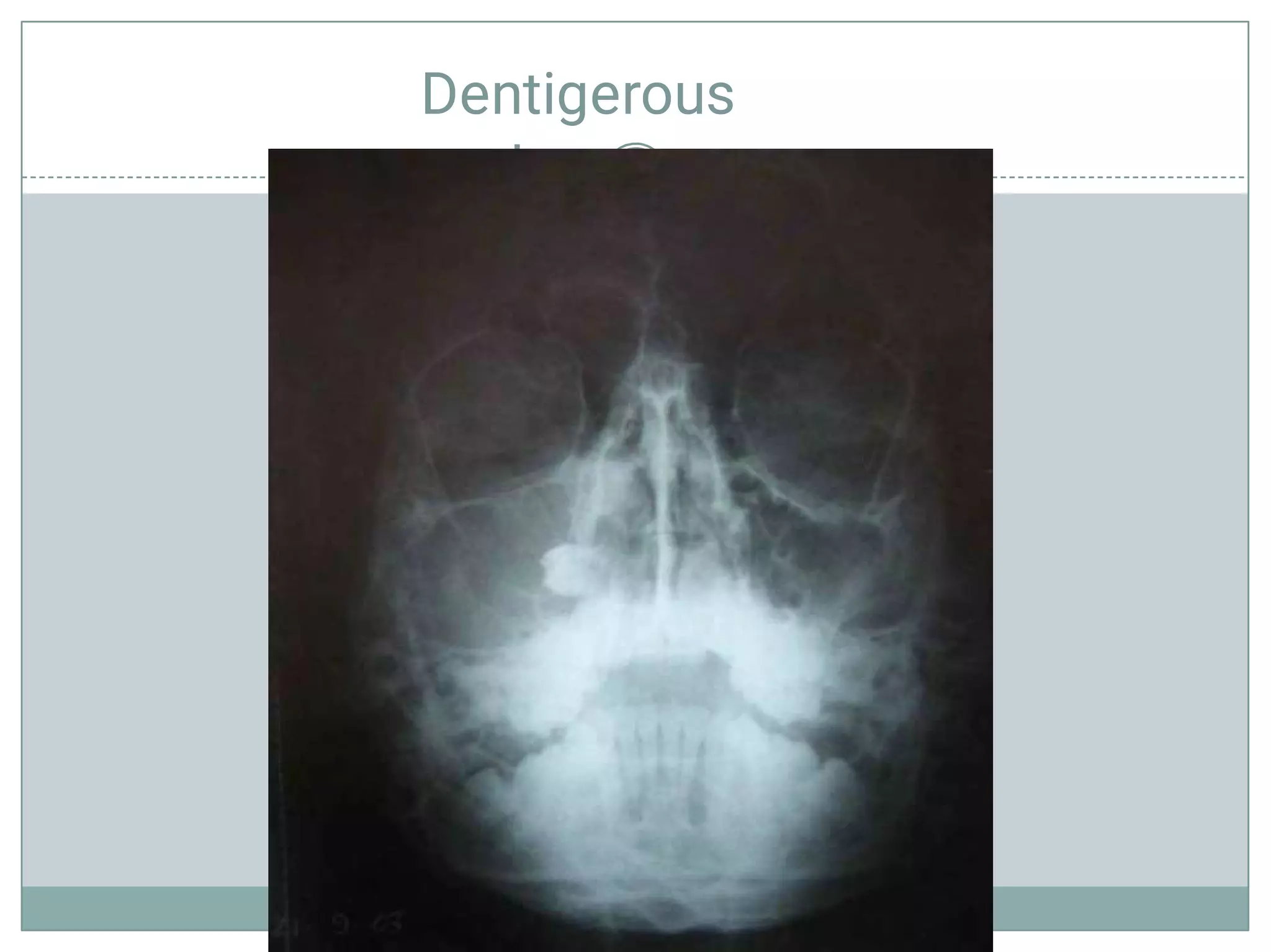 Radiology ENT.pdf | Ear, Nose and Throat Conditions | Diseases and ...