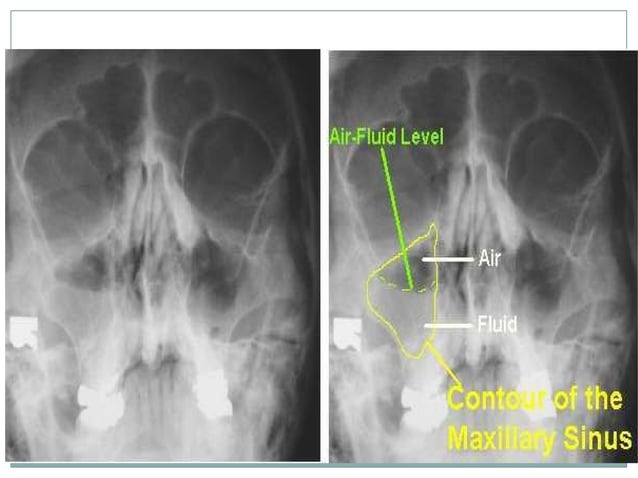 Radiology ENT.pdf | Ear, Nose and Throat Conditions | Diseases and ...