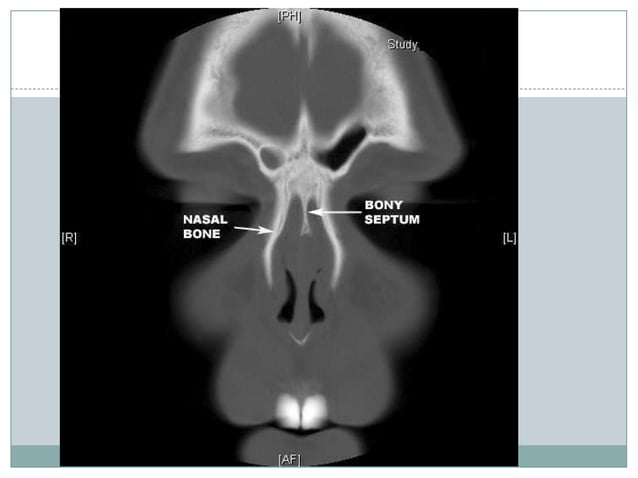 Radiology ENT.pdf | Ear, Nose and Throat Conditions | Diseases and ...