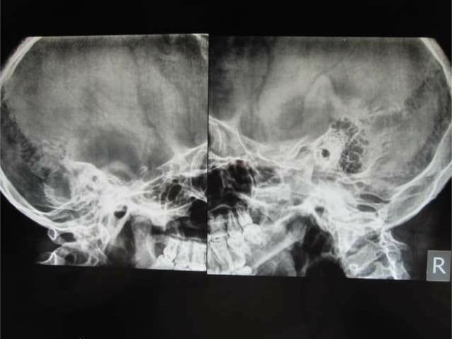 Radiology ENT.pdf | Ear, Nose and Throat Conditions | Diseases and ...