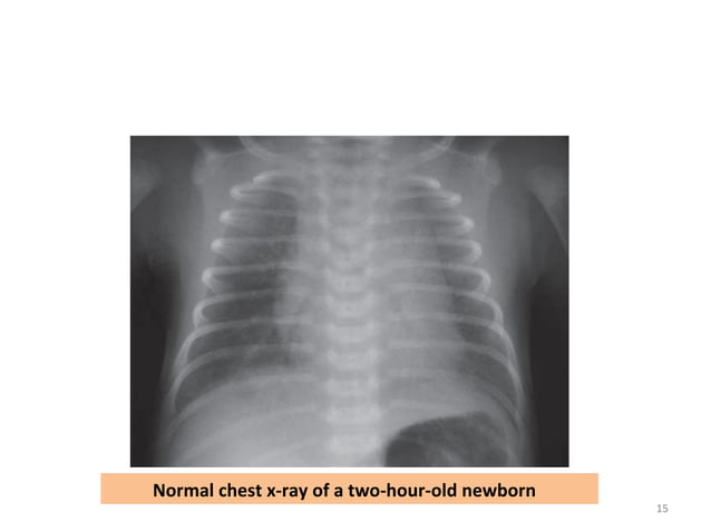Radiology in newborn collected by Dr. Saiful islam MD | PPT | Lung and ...
