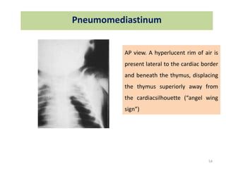 common neonatal Radiology findings | PPT