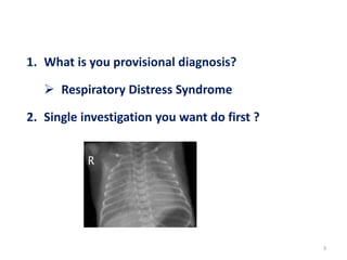 Respiratory Distress Syndrome X Ray