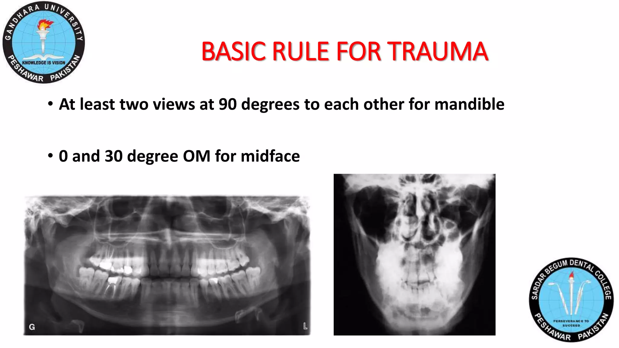 Radiology for Maxillofacial Trauma.pptx