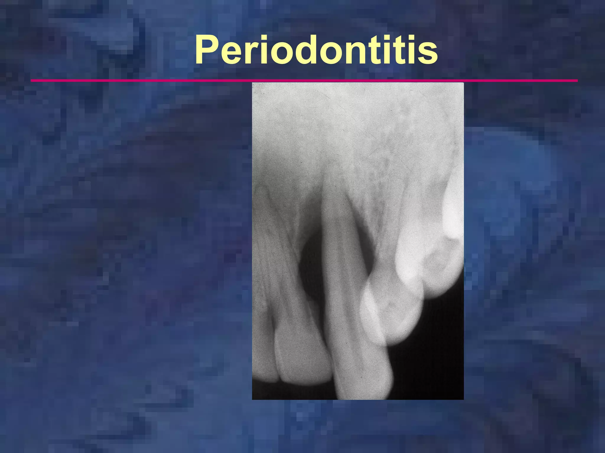 Radiology for periodental diseases | PPT