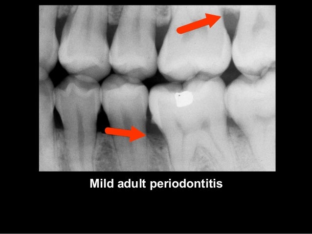 Radiology for periodental diseases